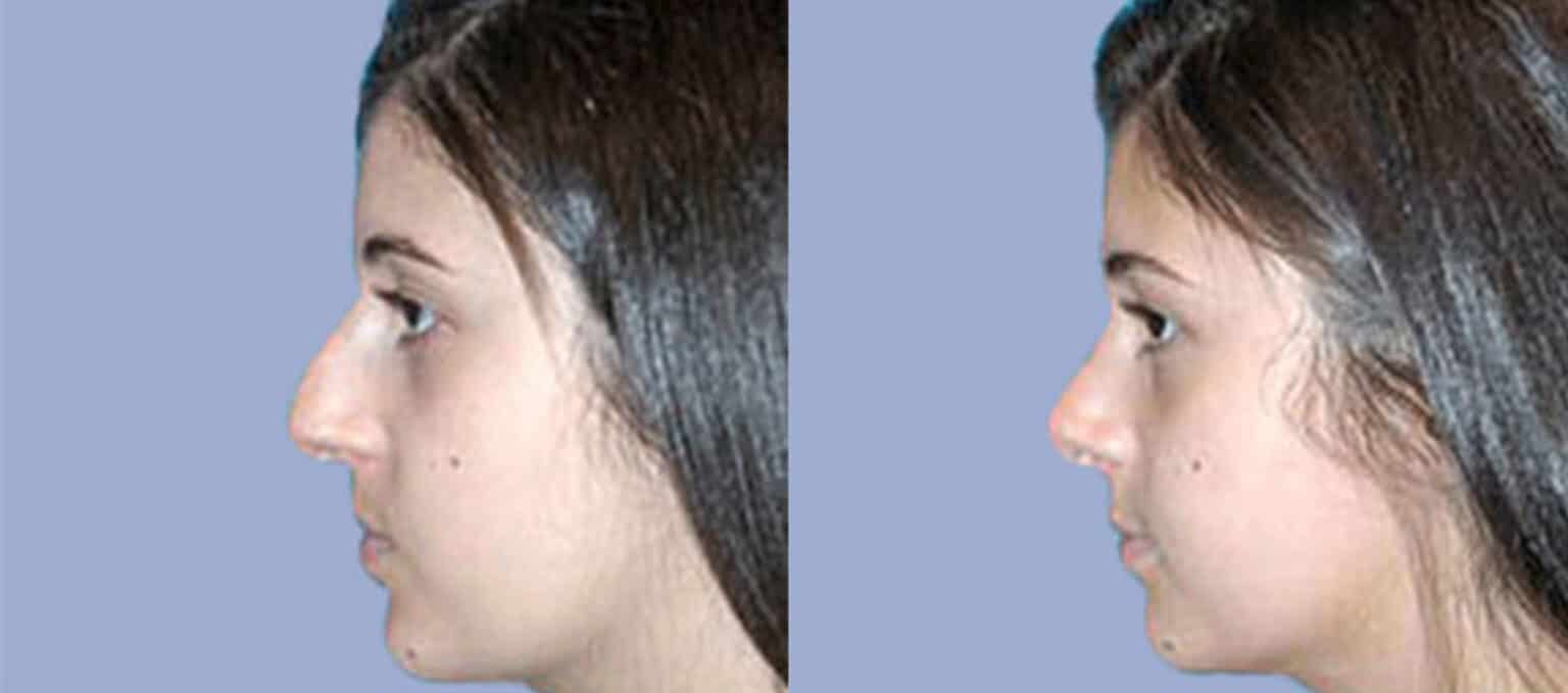 Children Rhinoplasty Surgery NYC - Child Nose Surgery NYC