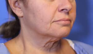 Platysmaplasty New York NY - Neck Band Correction NYC